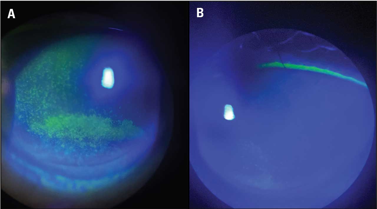 Premium IOLs for POAG Patients | Glaucoma Physician