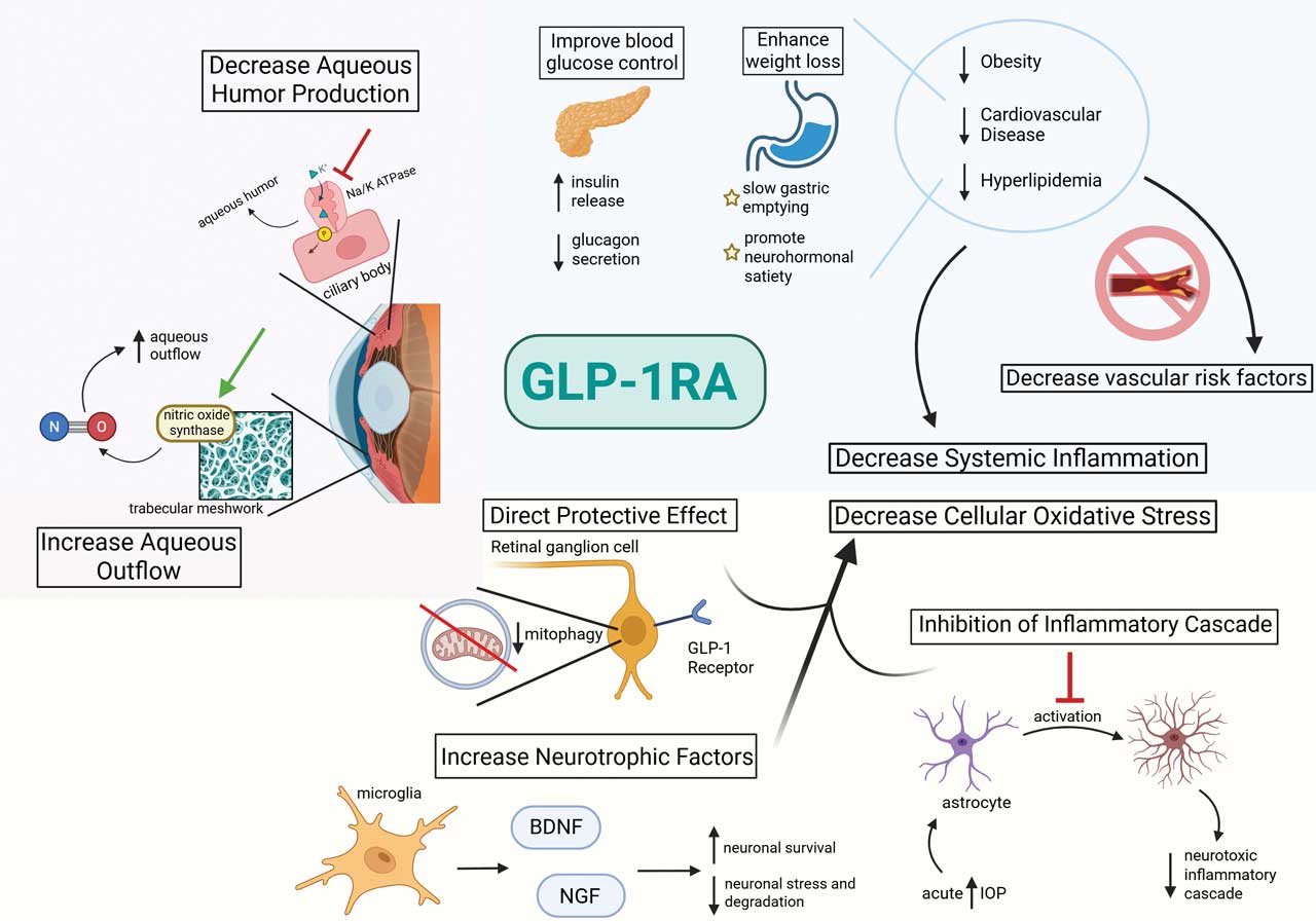 The Impact of GLP-1 Receptor Agonists on Ocular Disease | Glaucoma ...