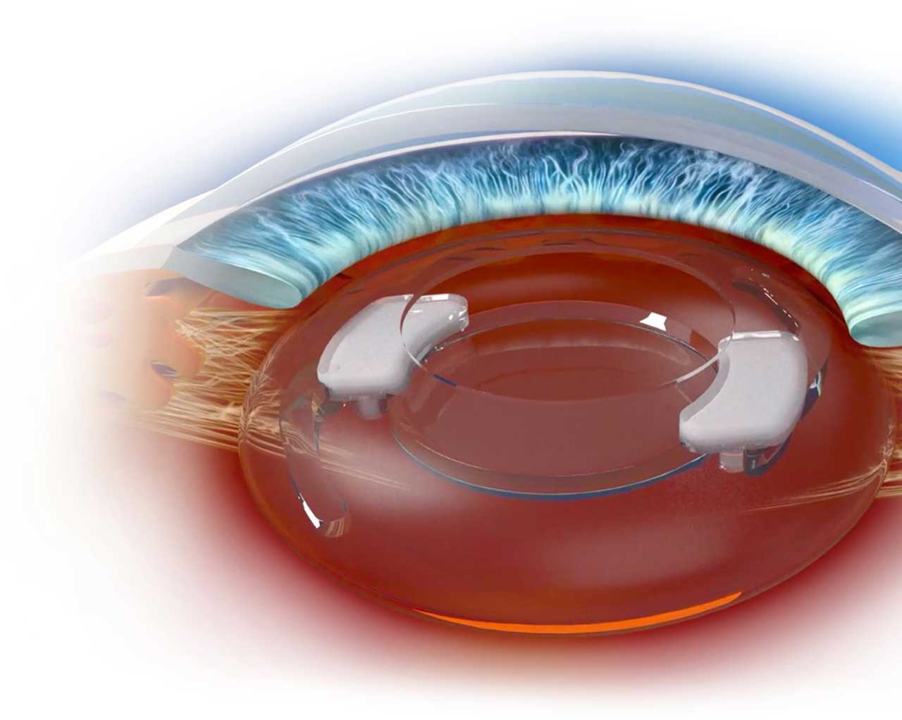Sustained-delivery Glaucoma Treatments | Glaucoma Physician Sustained-delivery Glaucoma Treatments | Glaucoma Physician