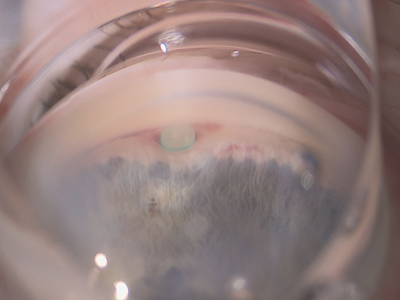 Glaucoma Physician | PentaVision