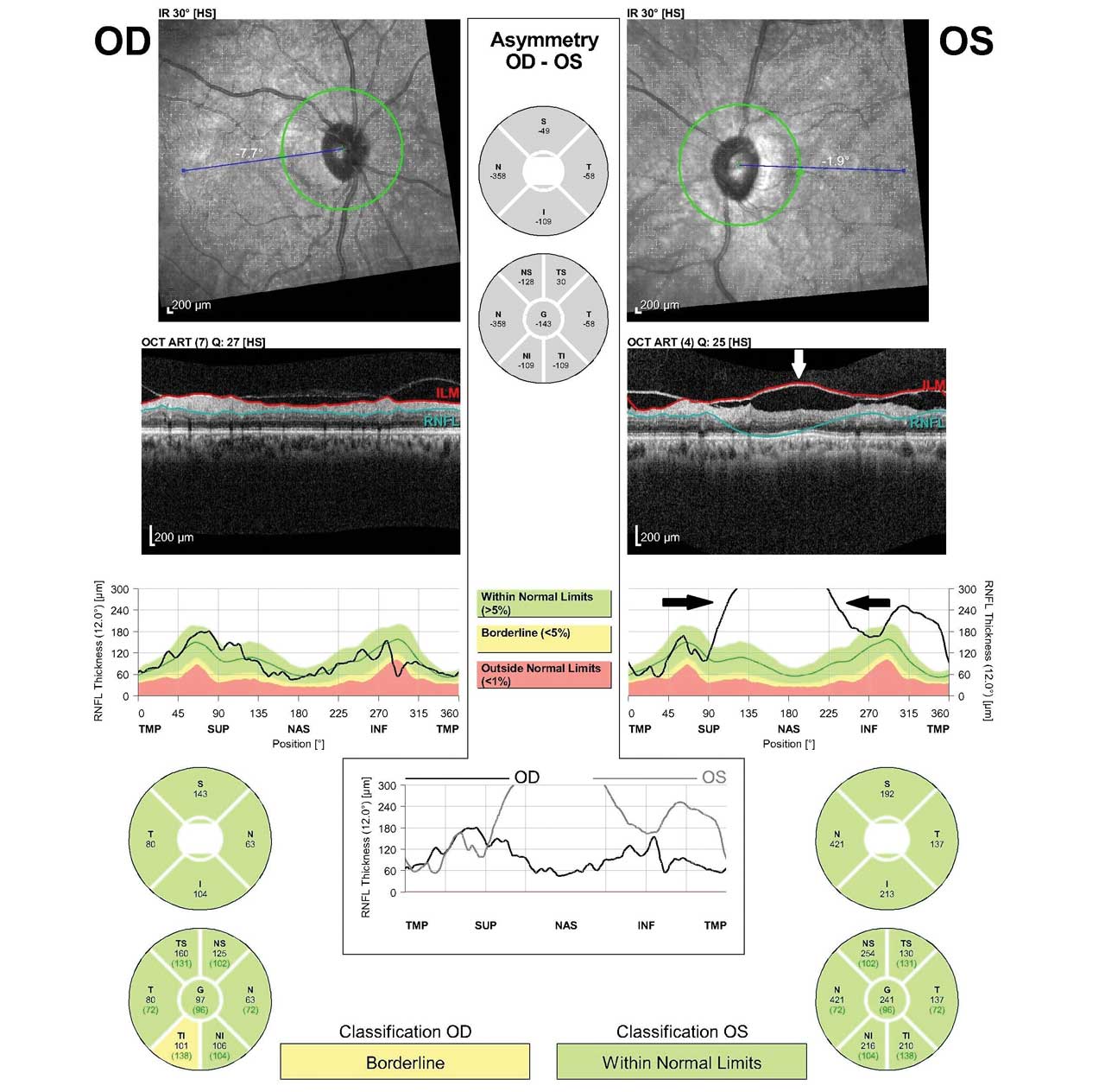 How to Detect and Interpret OCT Artifacts | Glaucoma Physician