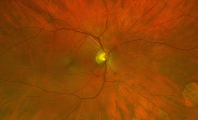 Unlocking the Supraciliary Space | Glaucoma Physician