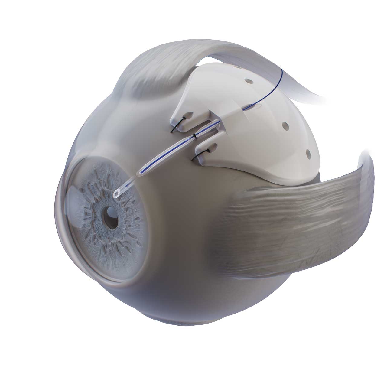 The Latest Step in Glaucoma Drainage Device Evolution | Glaucoma Physician