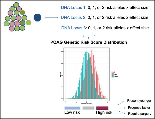 The Importance of Genetic Biomarkers for Glaucoma | Glaucoma Physician